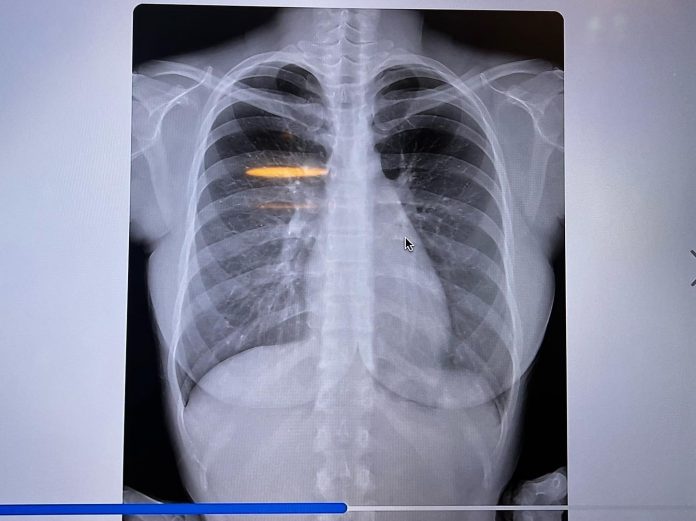 นางแบบคัพ I ญี่ปุ่น ถูกกล่าวหาว่าทำหน้าอก เลยโชว์ภาพ X-Ray เพื่อยืนยัน ...